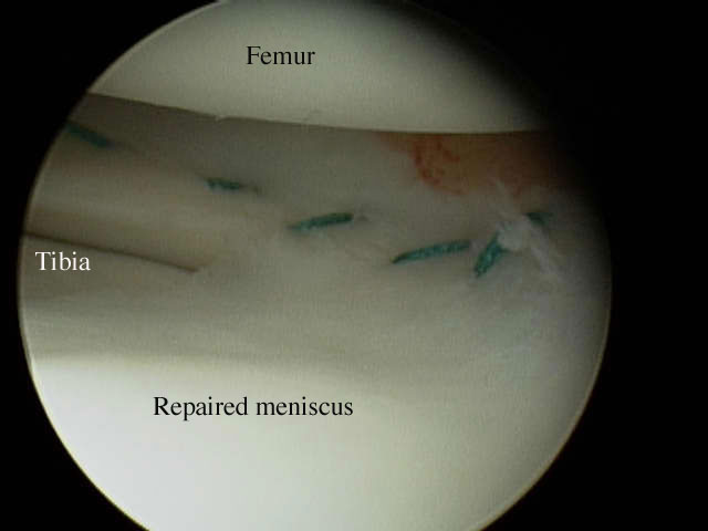 Arthroscopic Repair of Meniscal Tears in Children and Teenagers | UW Orthopaedics and Sports ...