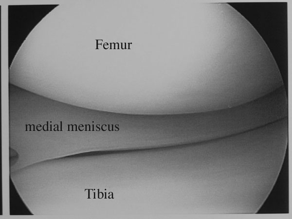 Arthroscopic Repair of Meniscal Tears in Children and Teenagers | UW ...
