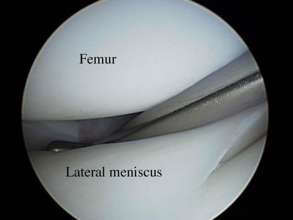 Arthroscopic Repair of Meniscal Tears in Children and Teenagers | UW ...