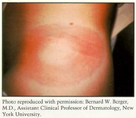 Lyme Disease | UW Orthopaedics and Sports Medicine, Seattle