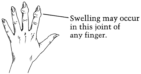 Osteoarthritis | UW Orthopaedics and Sports Medicine, Seattle