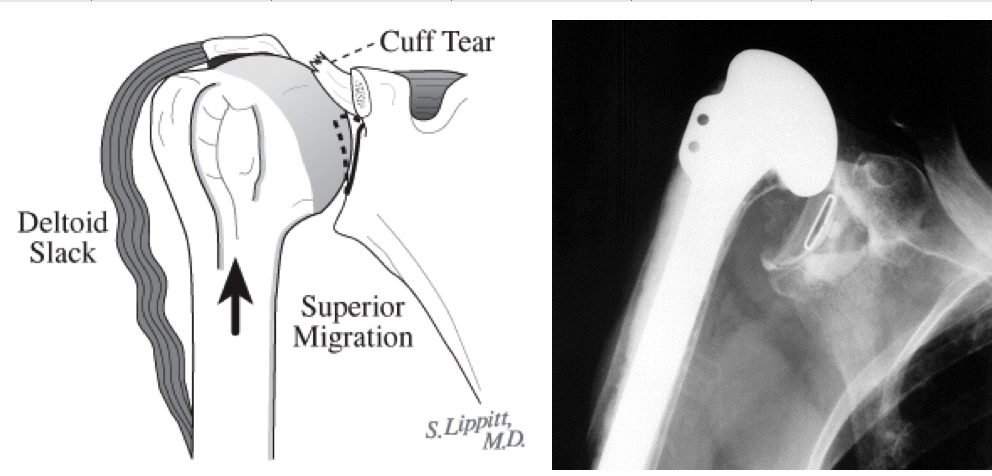 Reverse Total Shoulder or Delta Shoulder for Shoulder Arthritis ...