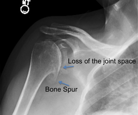 Shoulder Arthritis | UW Orthopaedics and Sports Medicine, Seattle