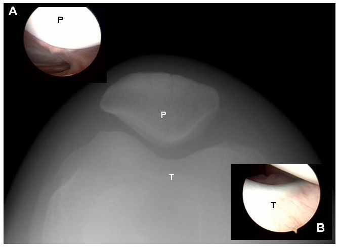 Micro Fractures for Athletes | UW Orthopaedics and Sports Medicine, Seattle