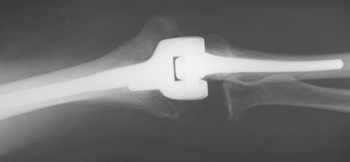 Total elbow joint replacement for elbow arthritis | UW Orthopaedics and ...