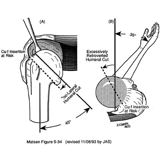 Mechanics of Glenohumeral Arthroplasty | UW Orthopaedics and Sports ...