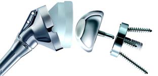 Reverse Shoulder Replacement | UW Orthopaedic Surgery and Sports Medicine